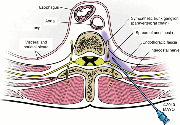 Thoracic and Lumbar Sympathetic Nerve Block and Neurolysis | SpringerLink