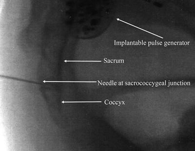 Superior Hypogastric Plexus, Ganglion Impar Blocks, and Neurolysis ...