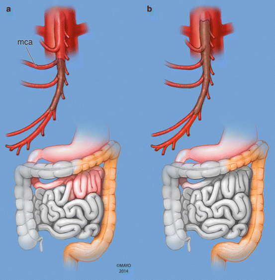 Technique of Open Mesenteric Catheter Embolectomy | SpringerLink