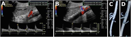 Duplex Ultrasound of the Mesenteric Vessels | SpringerLink