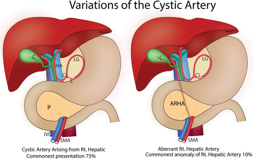 Extrahepatic Biliary Tract and Gallbladder | SpringerLink