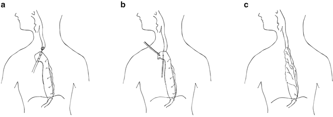 Open Technique for Ivor Lewis Esophagectomy | SpringerLink