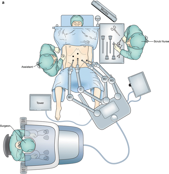 Hybrid Laparoscopic-Robotic Low Anterior Resection | SpringerLink