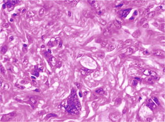 Atypical Fibroxanthoma/Undifferentiated Pleomorphic Sarcoma ...