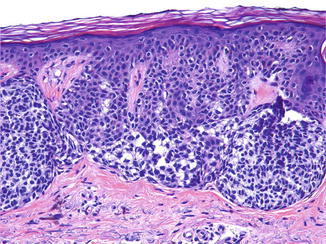 Nested Melanoma of the Elderly | SpringerLink