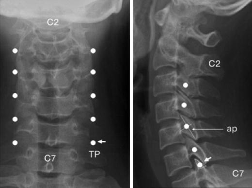 Cervical Injections | SpringerLink