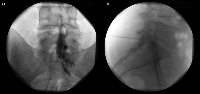 Lumbar Injections | SpringerLink