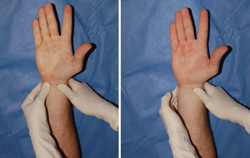 Arterial Cannulation (Radial and Femoral) | SpringerLink