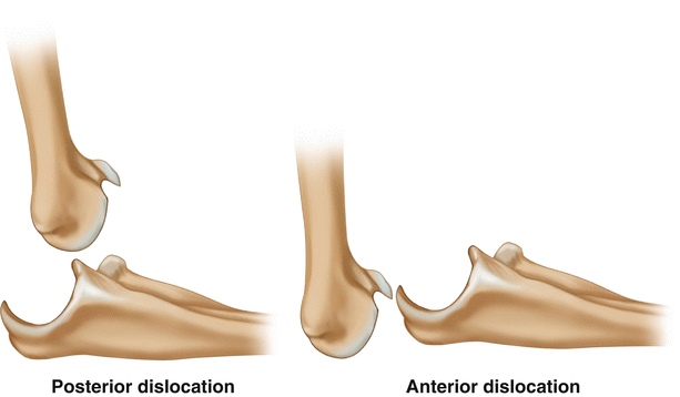 Elbow Dislocation Reduction | SpringerLink