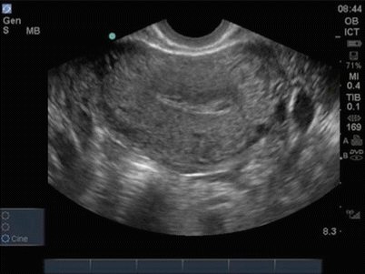 Ultrasonography for Threatened, Incomplete, or Compete Abortion ...