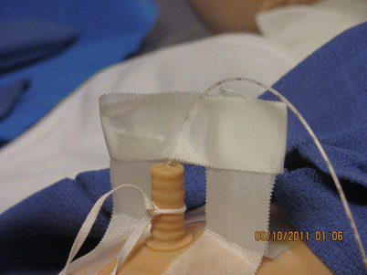 Umbilical Venous Catheters (Insertion and Removal) | SpringerLink