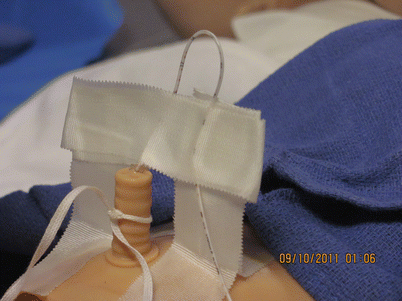 Umbilical Venous Catheters (Insertion and Removal) | SpringerLink