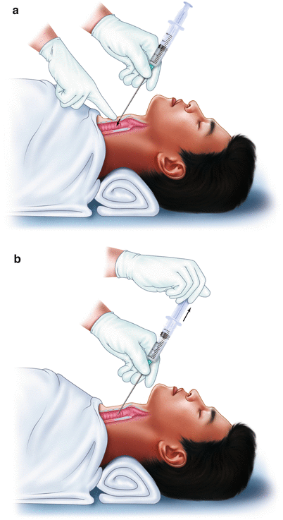 Percutaneous Transtracheal Jet Ventilation | SpringerLink