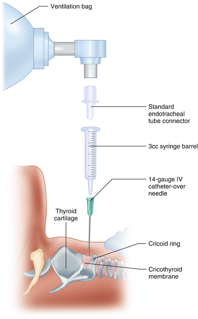 Percutaneous Transtracheal Jet Ventilation | SpringerLink