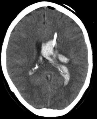 External Ventricular Drain Placement | SpringerLink