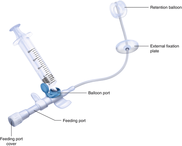 Gastrostomy Tube Placement | SpringerLink
