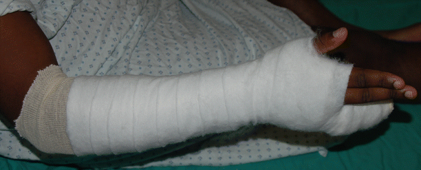 Ulnar Gutter Splint | SpringerLink