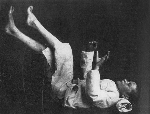 Catatonia in Psychiatric Illnesses | SpringerLink