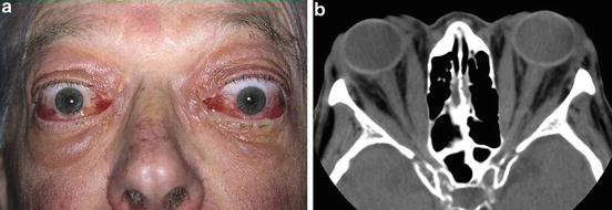 Assessment and Management Plan for Graves’ Orbitopathy | SpringerLink