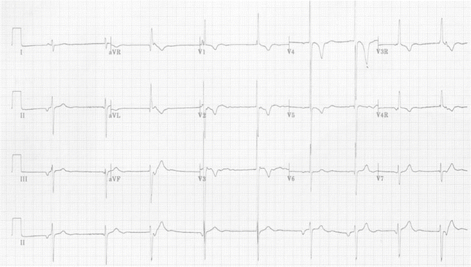 Sick Sinus Syndrome | SpringerLink