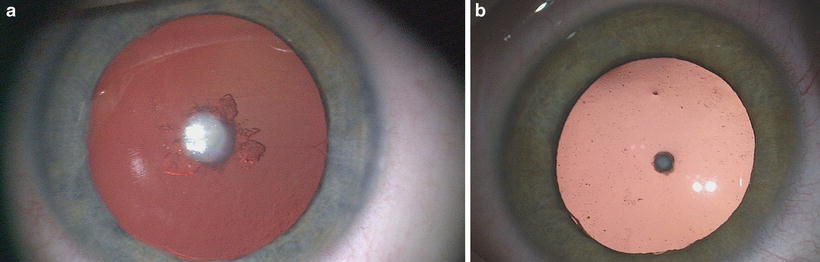 Management of Infantile and Childhood Cataracts | SpringerLink