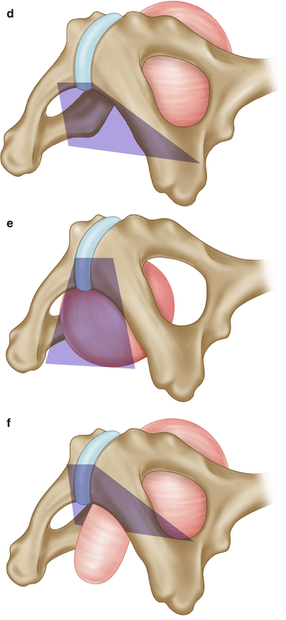 The Anatomy of Pelvic Support | SpringerLink