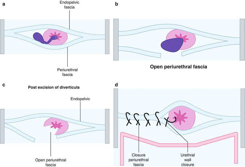 Excision of Urethral Diverticula | SpringerLink