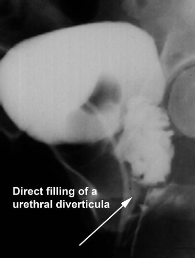 Excision of Urethral Diverticula | SpringerLink