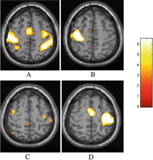Application of fMRI to Multiple Sclerosis and Other White Matter ...