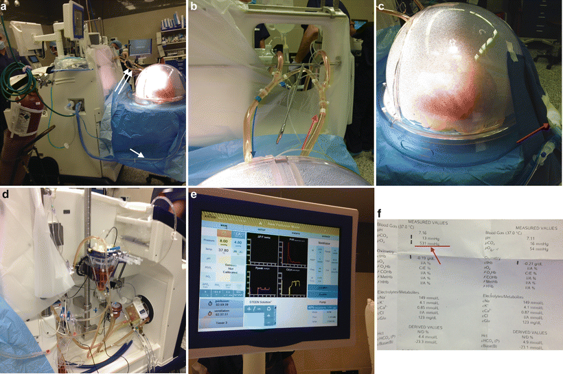 Perfusion Management for Thoracic Transplantation Surgery | SpringerLink