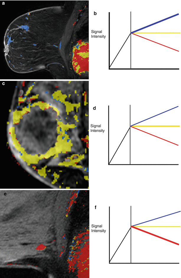 Breast MRI Basics | SpringerLink