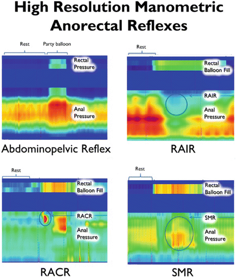 Anorectal Manometry | SpringerLink