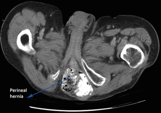 Pelvic Hernias | SpringerLink