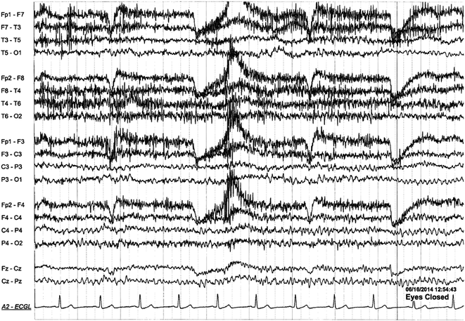 EEG Instrumentation, Montage, Polarity, and Localization | SpringerLink