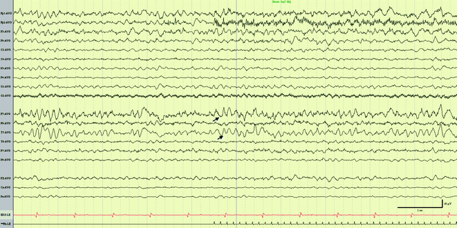 Normal EEG Variants and Artifacts | SpringerLink