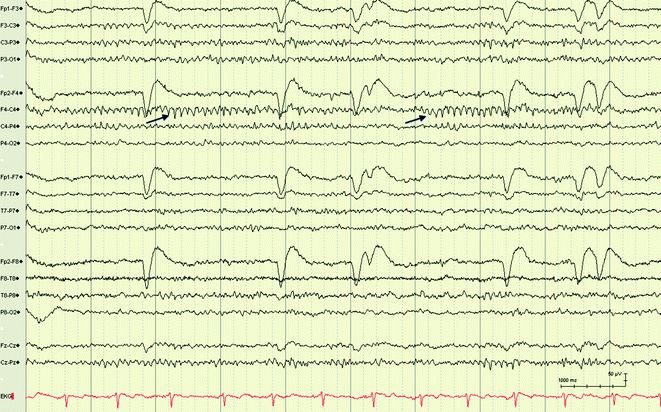 Normal EEG Variants and Artifacts | SpringerLink