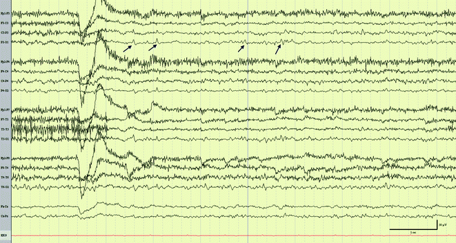Normal EEG Variants and Artifacts | SpringerLink