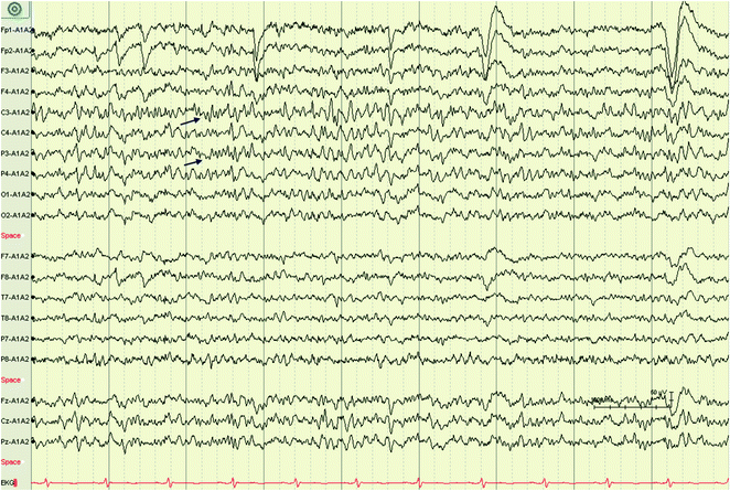 Normal EEG Variants and Artifacts | SpringerLink