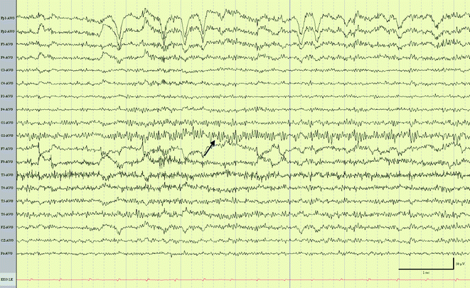 Normal EEG Variants and Artifacts | SpringerLink