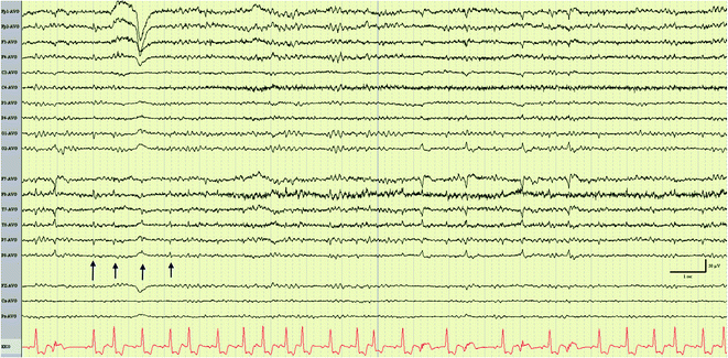Normal EEG Variants and Artifacts | SpringerLink