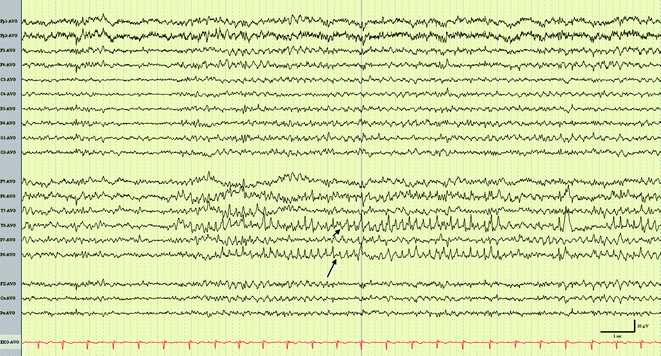 Normal EEG Variants and Artifacts | SpringerLink