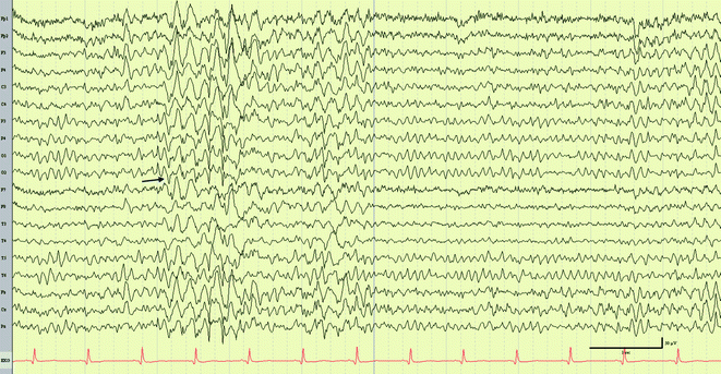 Normal EEG Variants and Artifacts | SpringerLink
