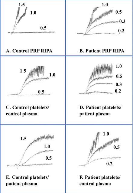 Ristocetin-Induced Platelet Aggregation (RIPA) and RIPA Mixing Studies ...