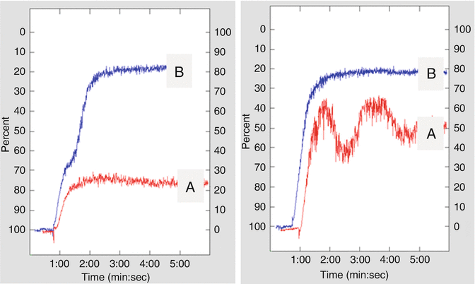 Ristocetin-Induced Platelet Aggregation (RIPA) and RIPA Mixing Studies ...