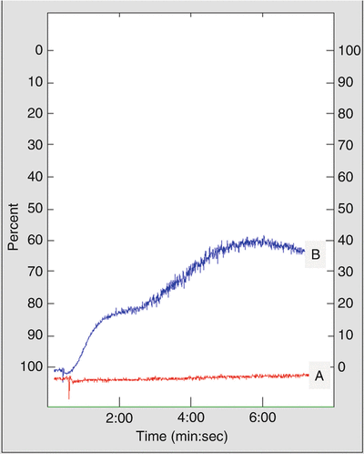 Ristocetin-Induced Platelet Aggregation (RIPA) and RIPA Mixing Studies ...