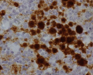 Kuru: Introduction to Prion Diseases | SpringerLink