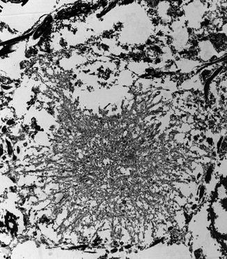 Kuru: Introduction to Prion Diseases | SpringerLink