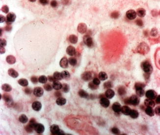 Kuru: Introduction to Prion Diseases | SpringerLink