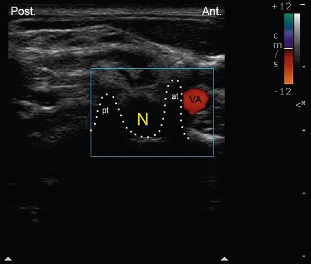 Ultrasound-Guided Cervical Nerve Root Block | SpringerLink