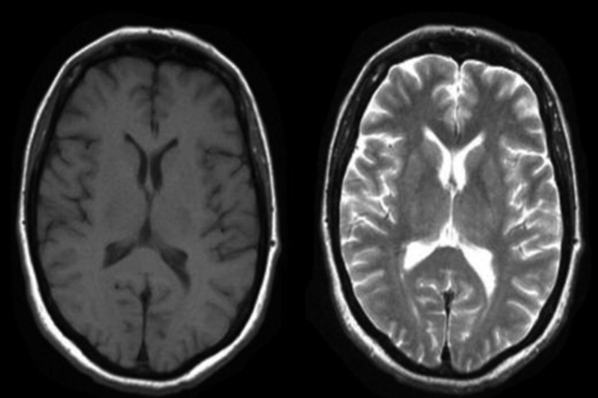 Magnetic Resonance Imaging in Huntington’s Disease | SpringerLink